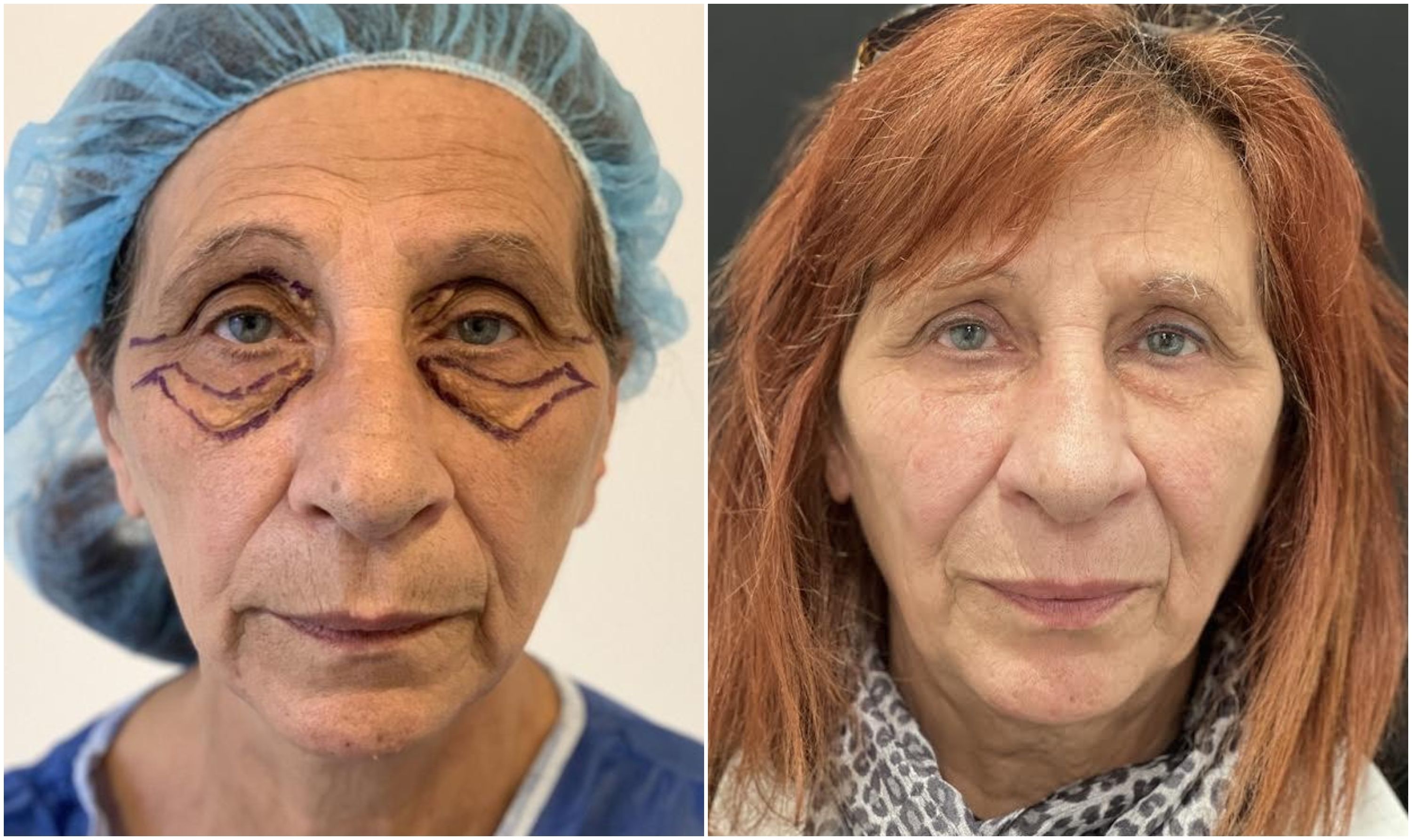 Xantelasmi Prima e dopo - Guidaestetica.it