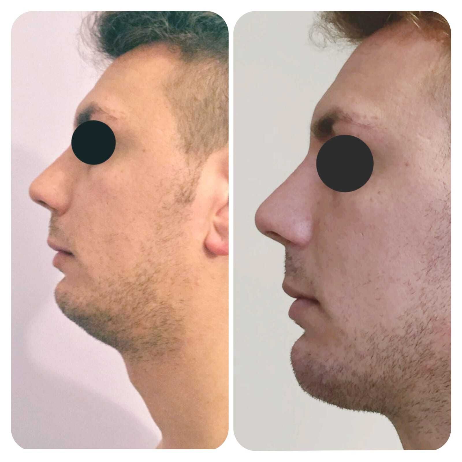 Mentoplastica Prima e dopo - Guidaestetica.it