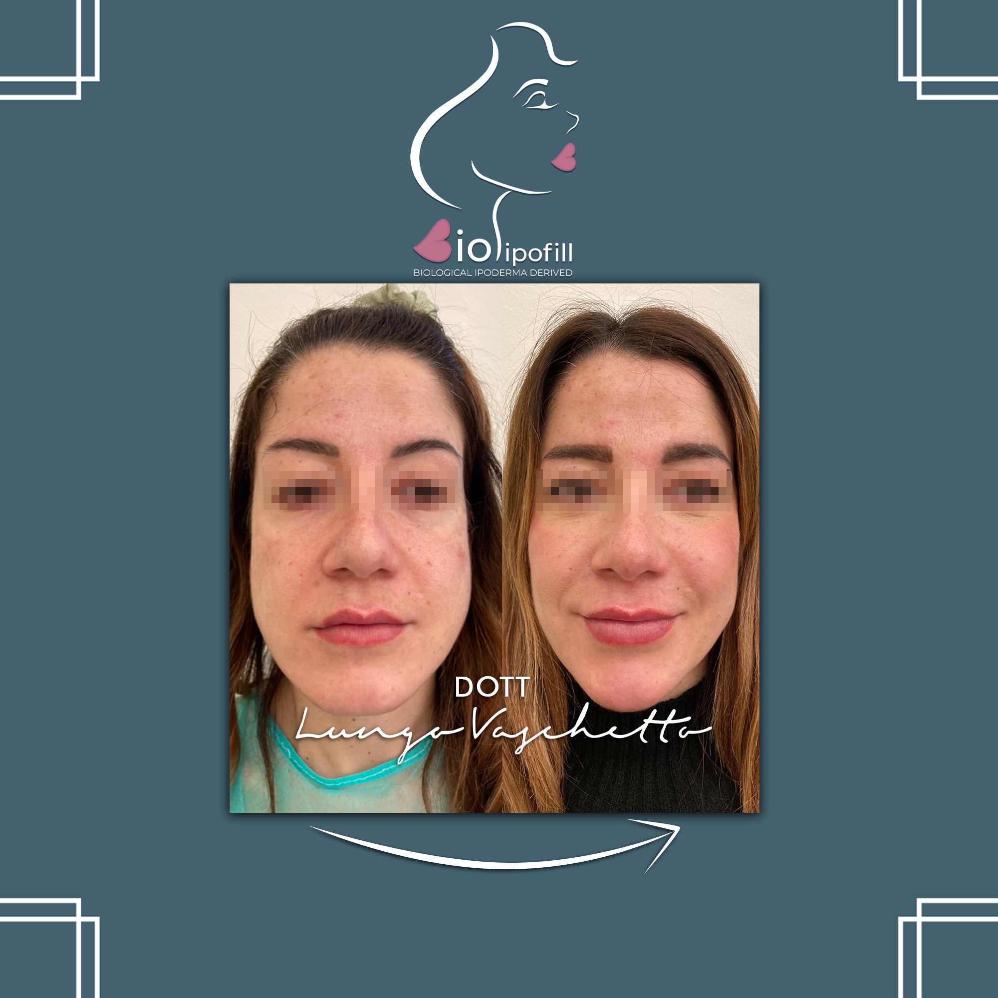 Lipofilling Prima e dopo - Guidaestetica.it