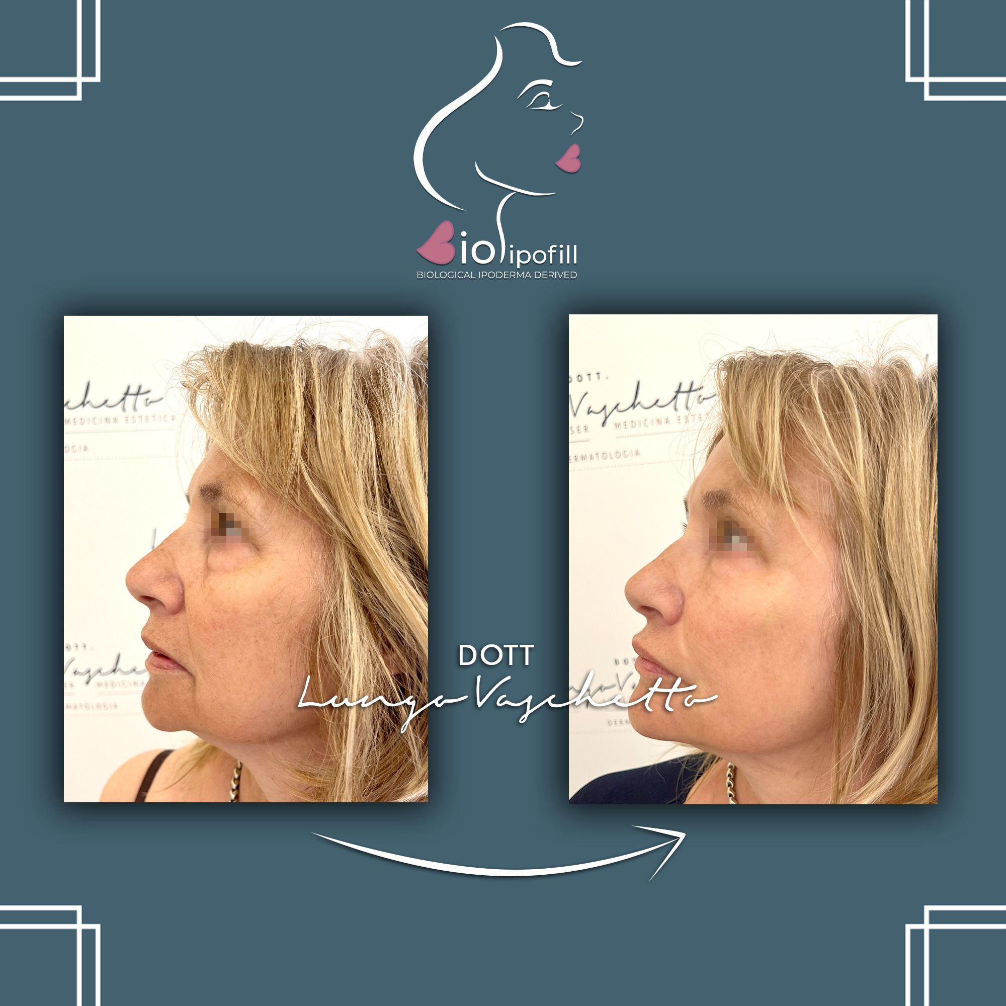 Lipofilling Prima e dopo - Guidaestetica.it - Guidaestetica.it