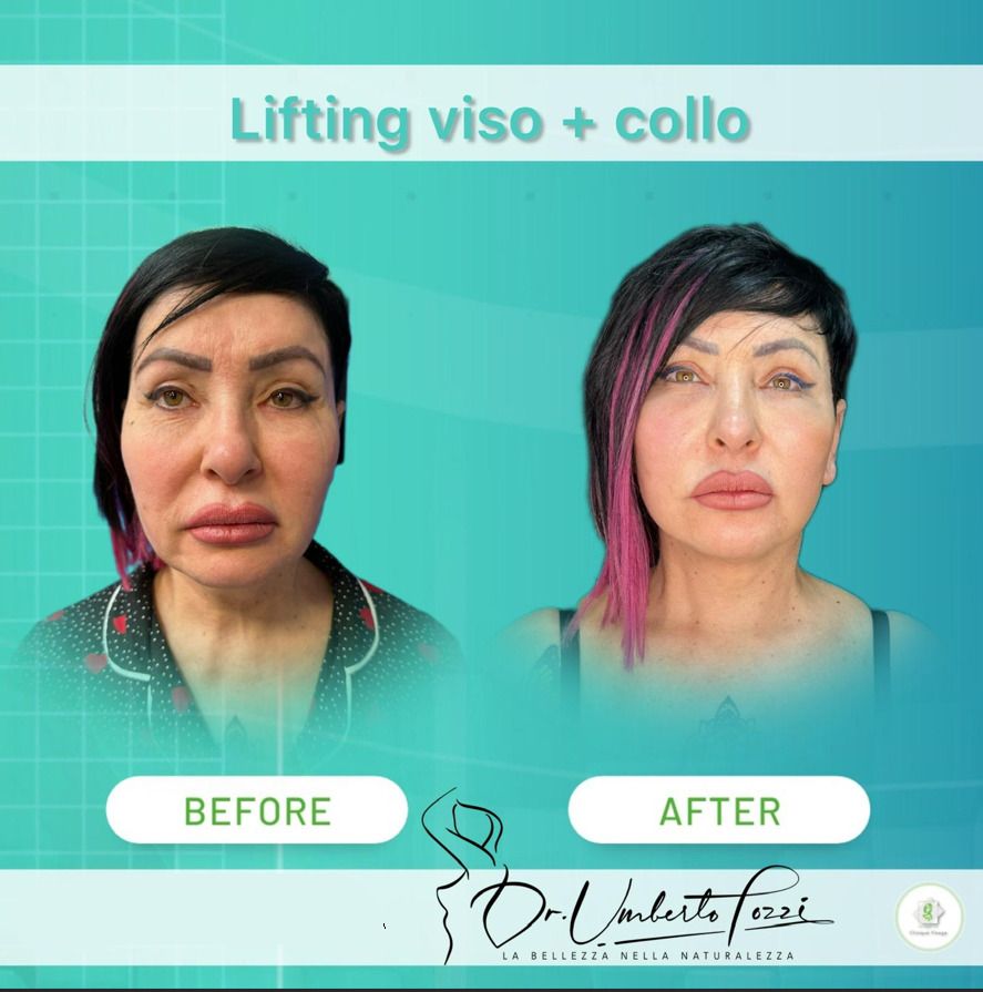 Lifting viso Prima e dopo - Guidaestetica.it - Guidaestetica.it