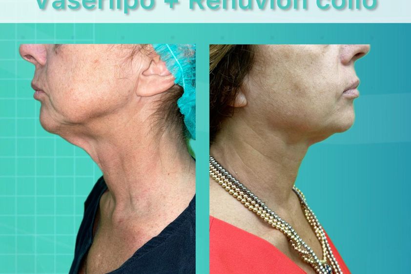 Lipo Vaser: esperienze, prezzi, dottori, foto e altro - Guidaestetica.it