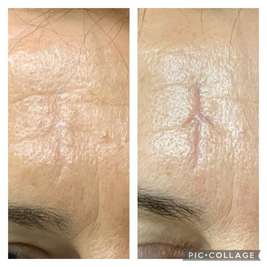 Cicatrici Prima e dopo - Guidaestetica.it - Guidaestetica.it