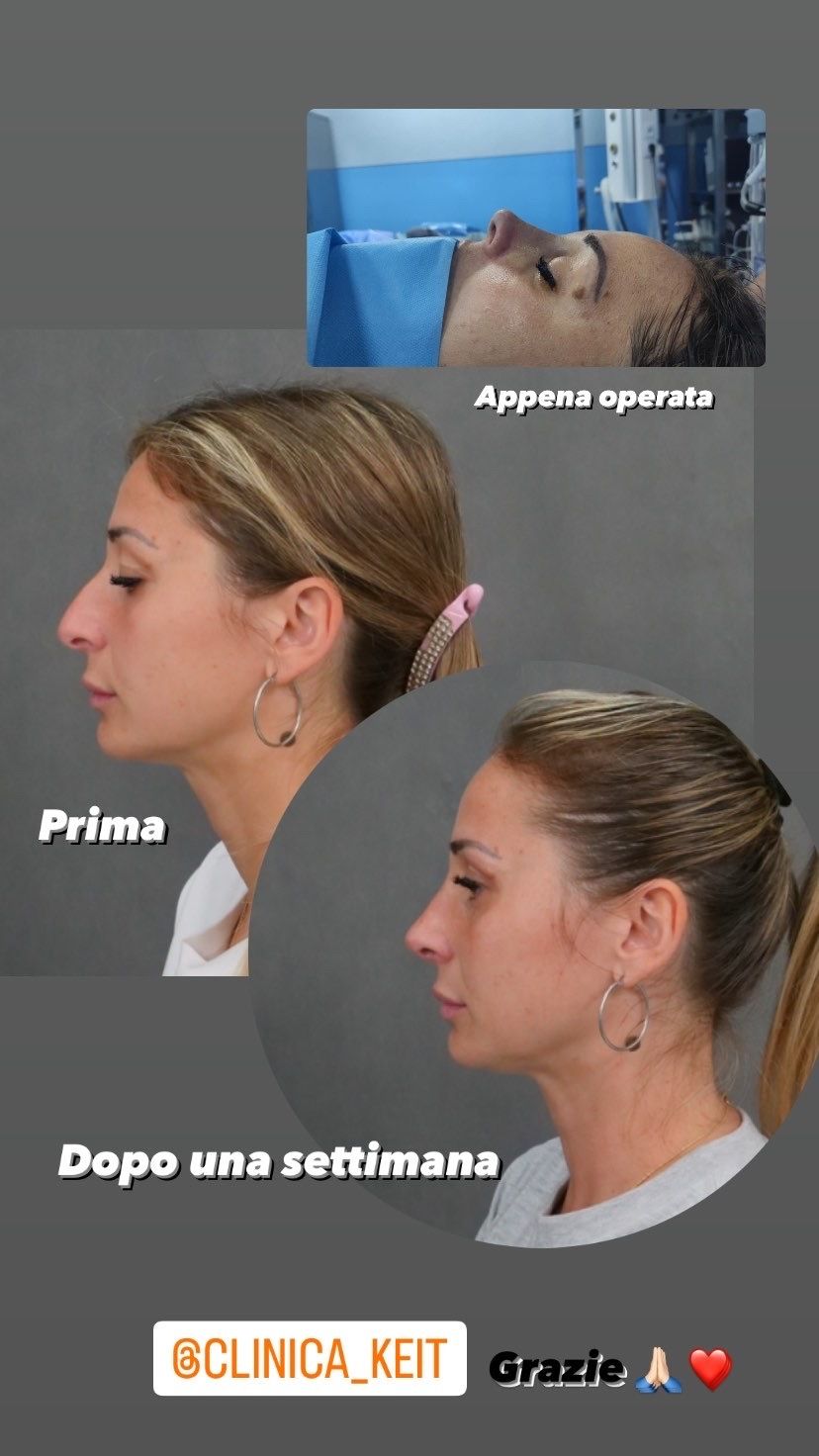 Rinoplastica- mi sono operata alla clinica Keit il 13 giugno del 2022 ...