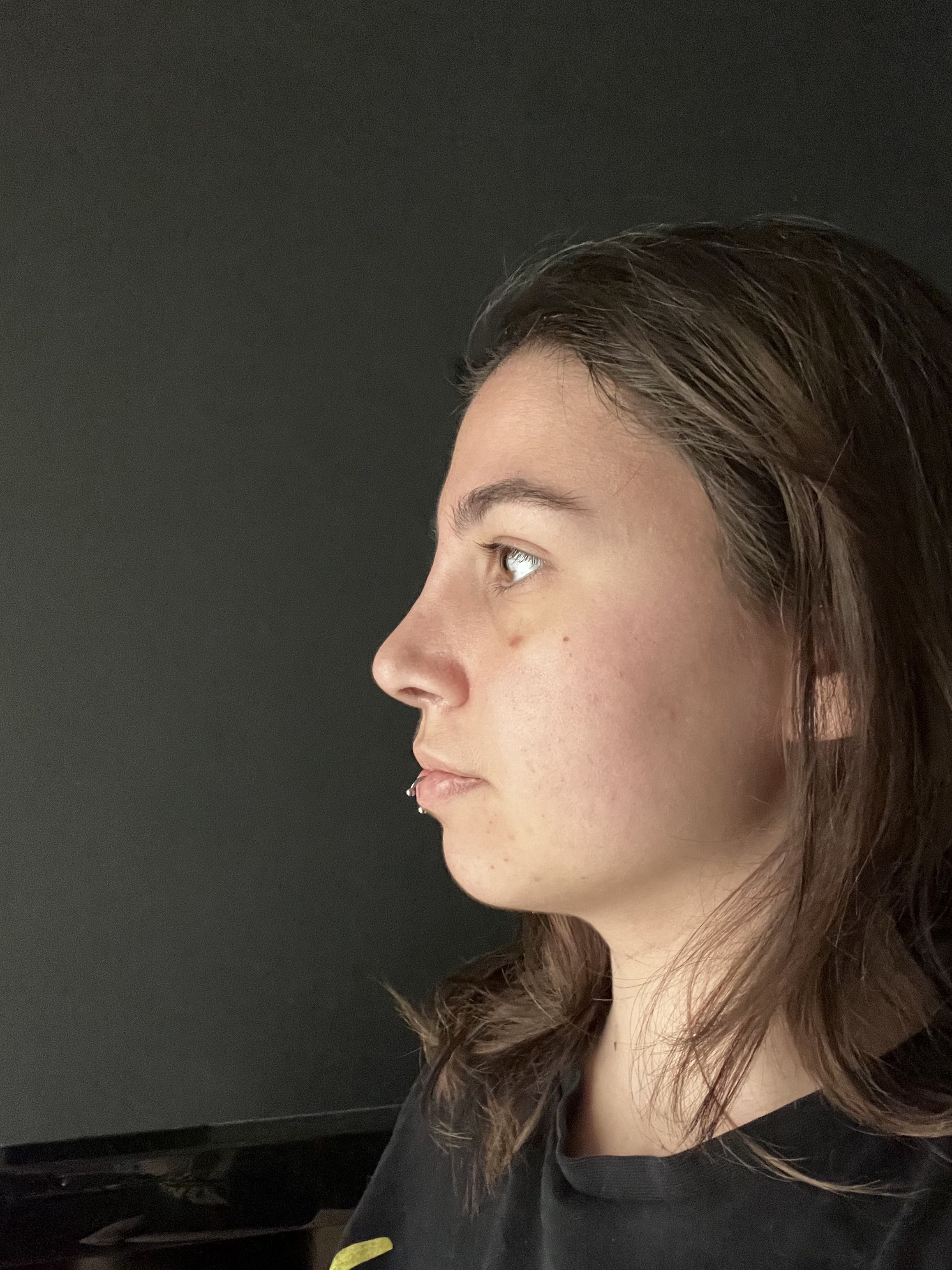 Rinoplastica alla clinica Keit - Rinoplastica - Guidaestetica.it