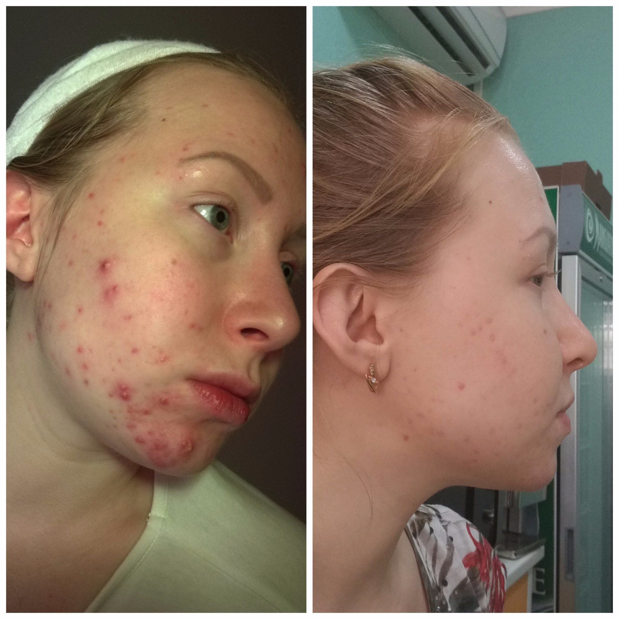 Addio acne cistica! Grazie isotretinoina! - Acne - Guidaestetica.it