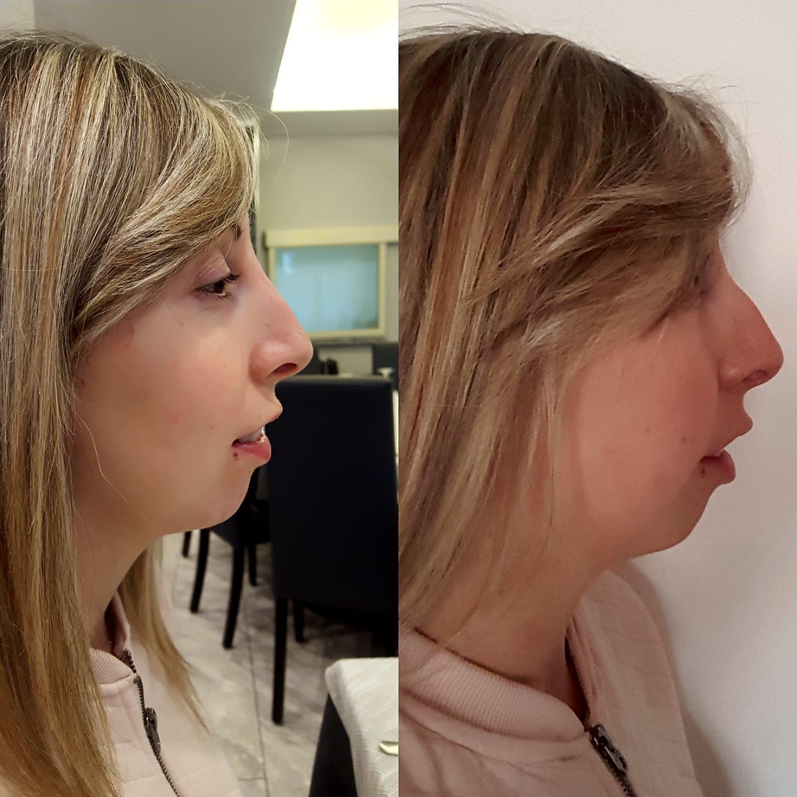 Rinofiller e filler mento top! - Rinofiller - Guidaestetica.it