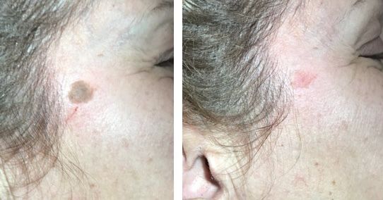 Trattamento macchia della pelle - Macchie della pelle - Guidaestetica.it