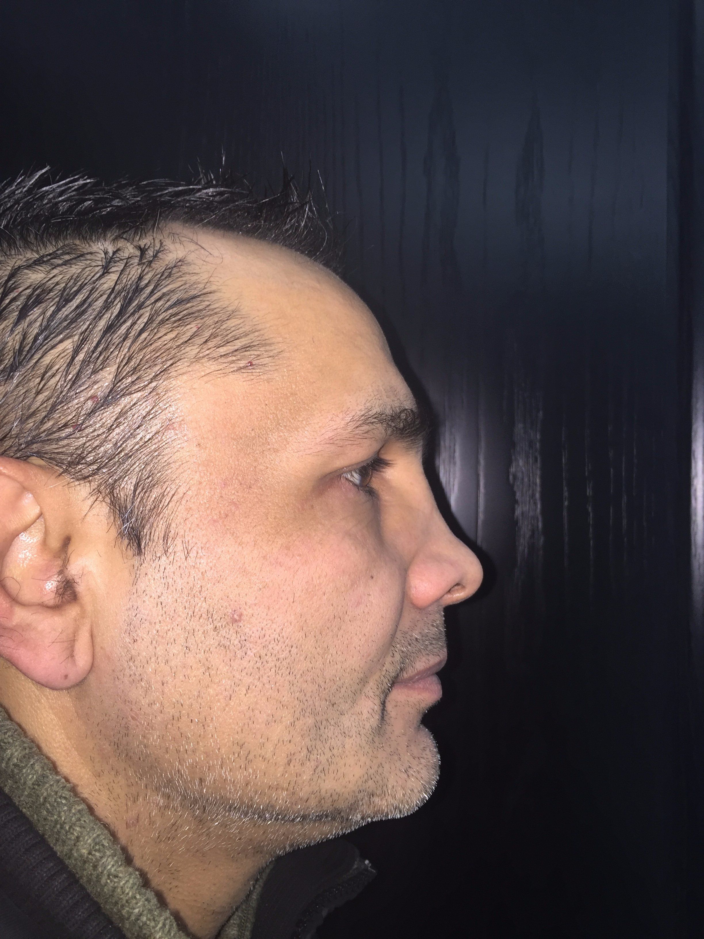 chirurgia rinoplastica mi sono pentito di agiustare il mio naso rotto ...