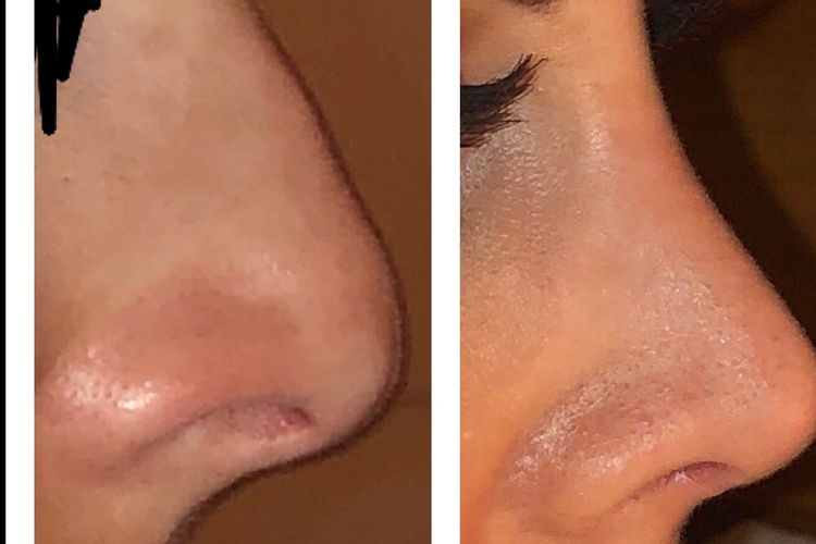 Problemi di fibrosi post rinoplastica: come risolvere? - Guidaestetica.it