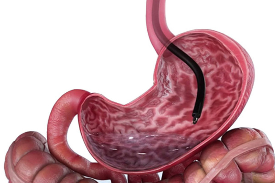 Apollo Endosurgery - Guidaestetica Brands