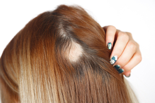 Capelli a chiazze - Guidaestetica.it